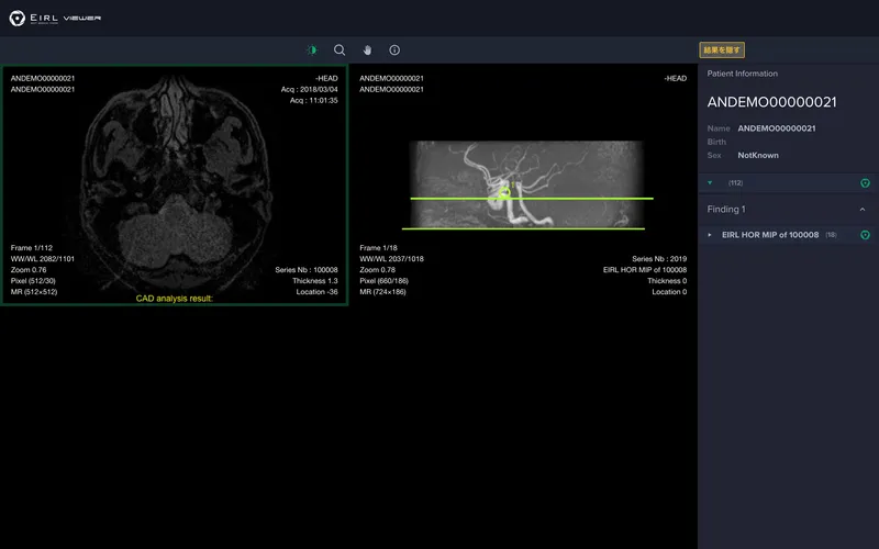 EIRL Brain Aneurysm｜HAIPカタログサイト